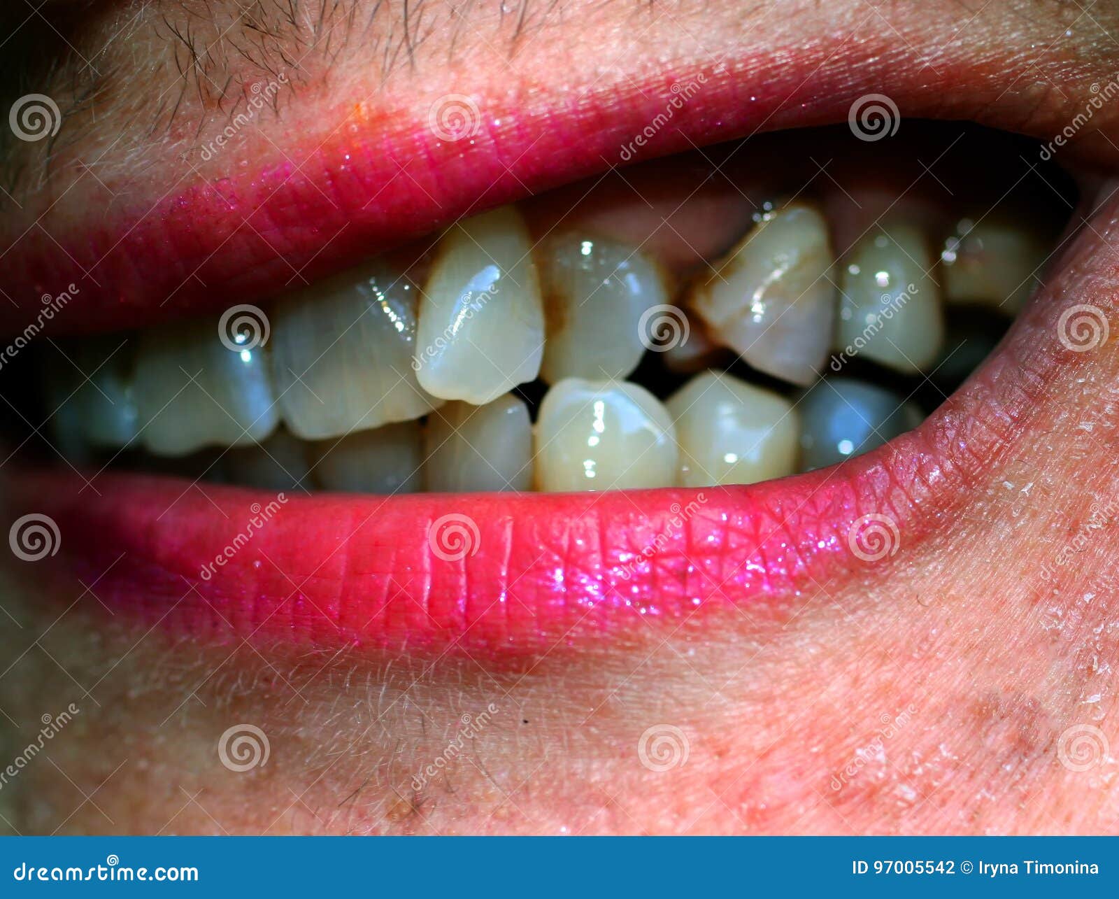 Crooked Teeth in the Mouth. Orthodontics. Malocclusion. Stock Photo ...