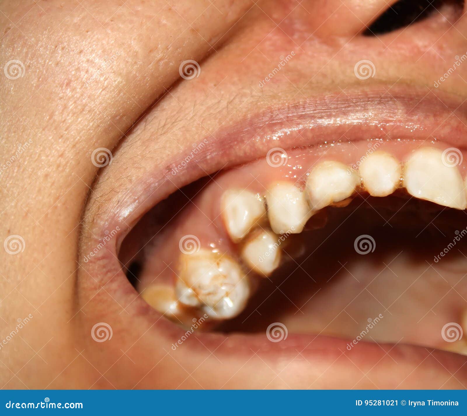 Crooked Teeth. Orthodontics. Underdevelopment and Defects of Teeth ...