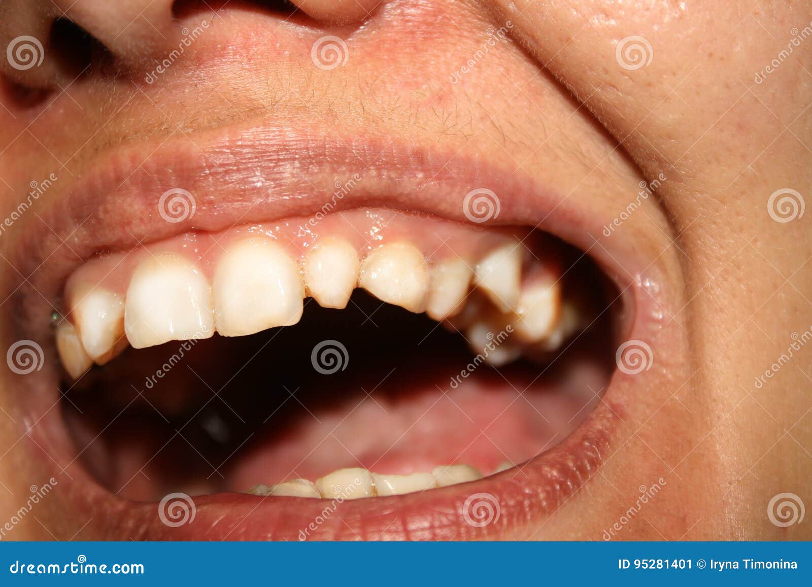 Crooked Teeth. Orthodontics. Underdevelopment and Defects of Teeth ...