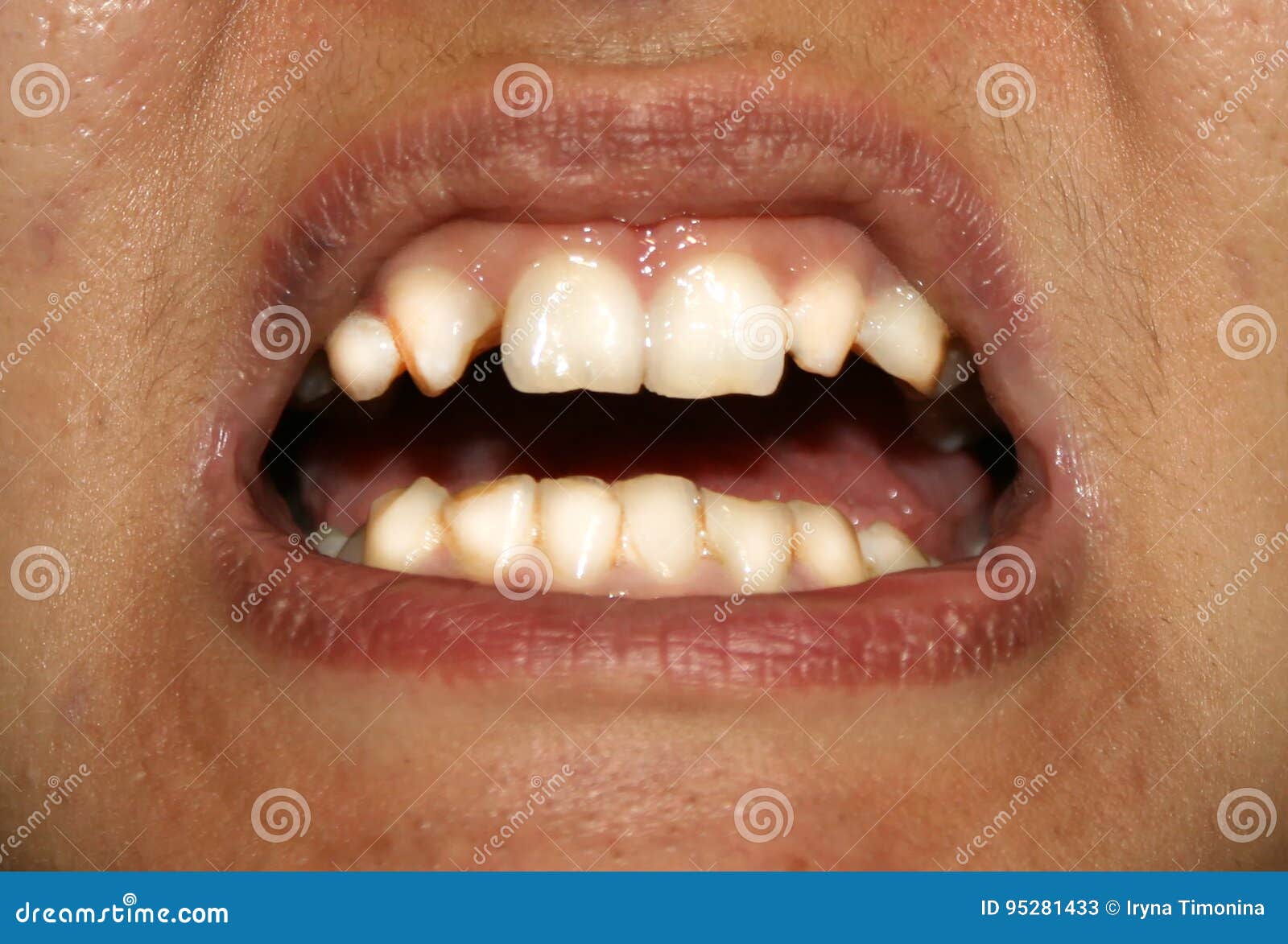 Crooked Teeth. Orthodontics. Underdevelopment and Defects of Teeth ...