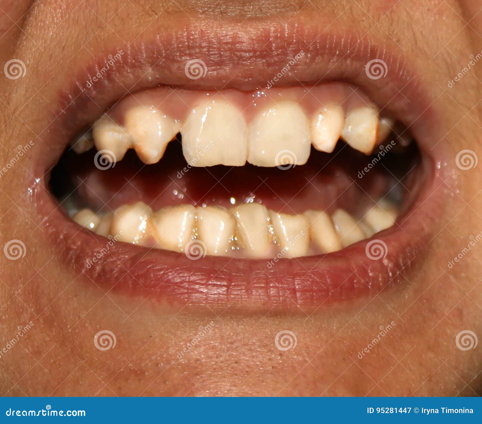 Crooked Teeth. Orthodontics. Underdevelopment and Defects of Teeth ...