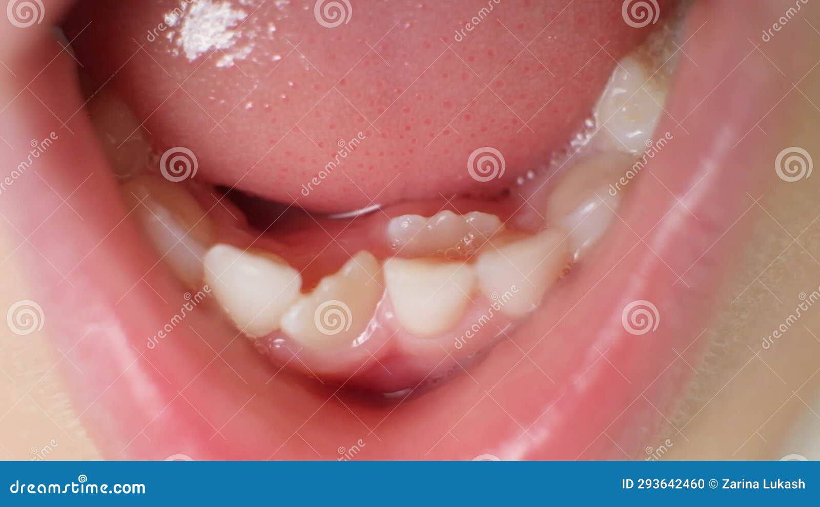 Crookedly Growing Teeth To Replace Milk Teeth in a Child. the Second ...