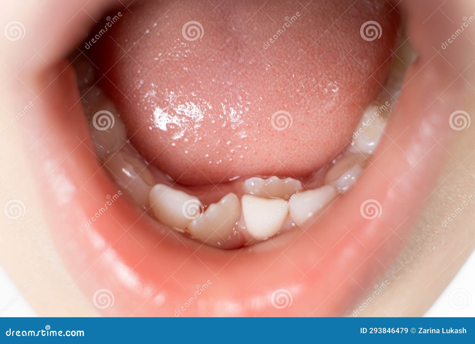 Crookedly Growing Teeth To Replace Milk Teeth in a Child. the Second ...