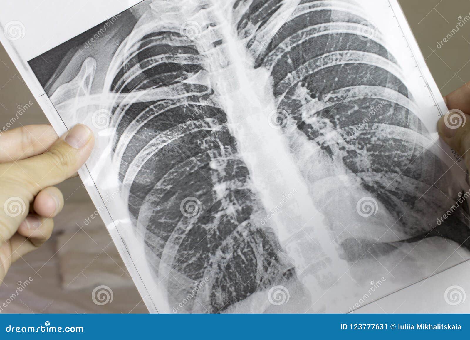 Cropped Hands Holding Fluorography, X-ray. Lung Desease Concept. Stock ...