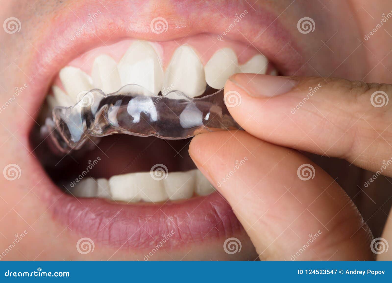 Man Adjusting Transparent Aligners in Teeth Stock Image - Image of ...