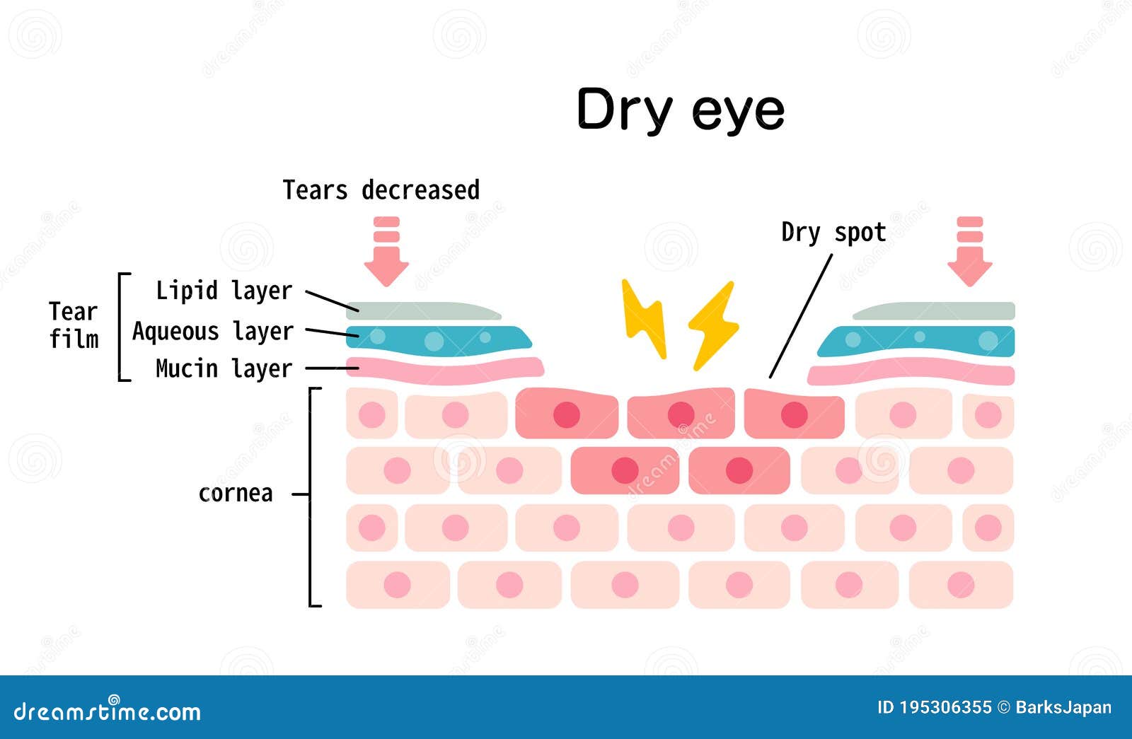 Cross Section of Dry Eye Surface. Flat Vector Illustration Stock Vector ...