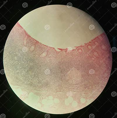Cross Section through a Human Appendix Stock Photo - Image of body ...