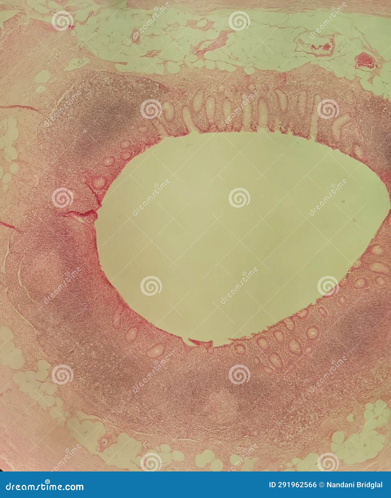 Cross Section through a Human Appendix Stock Photo - Image of circle ...