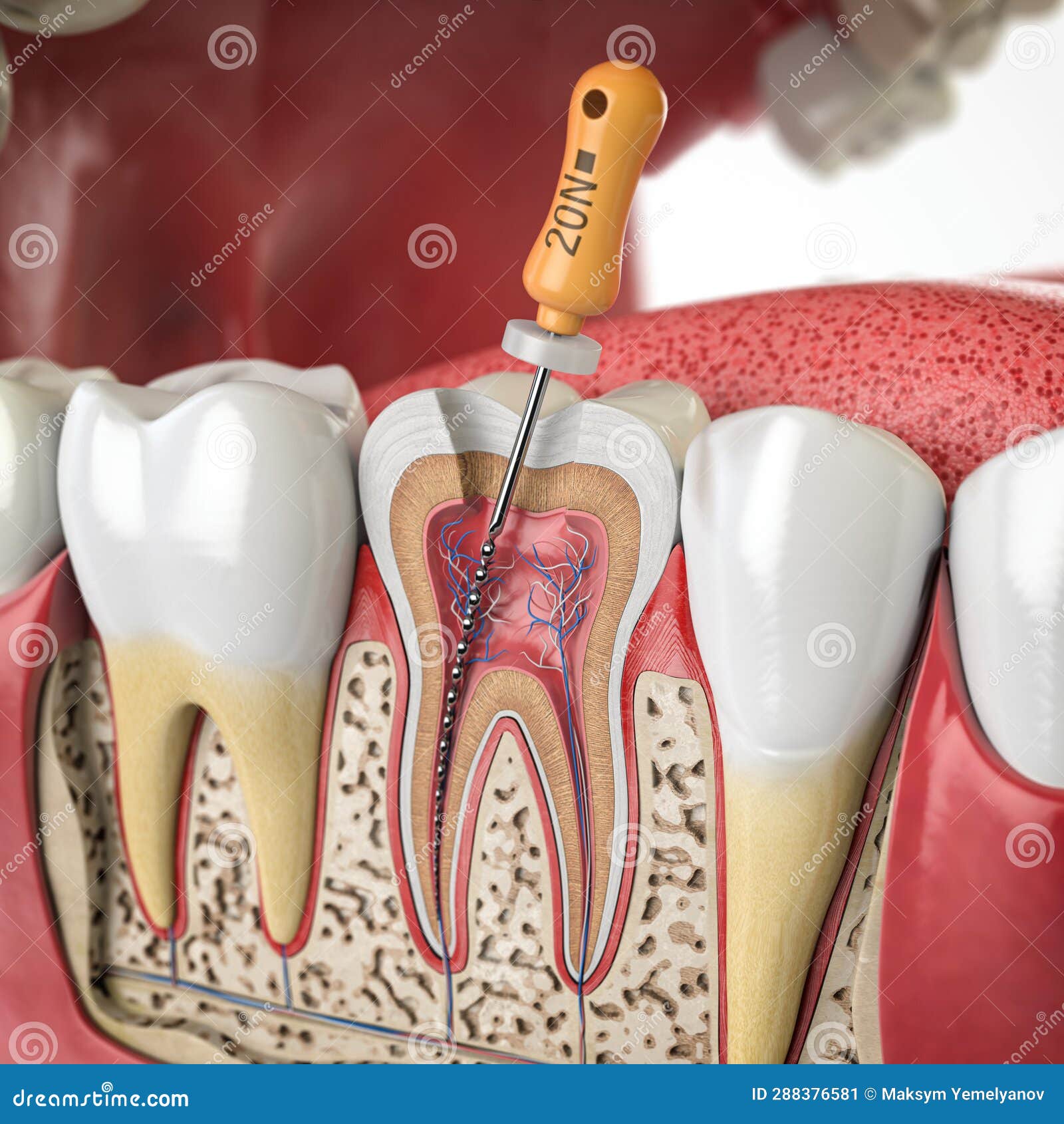 Cross Section of Human Tooth with Endodontic Rotary File Stock ...