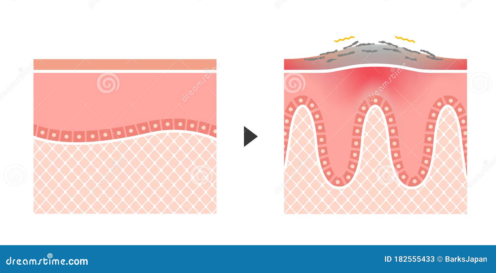 Cross Section of Psoriasis and Normal Skin / Flat Vector Illustration ...