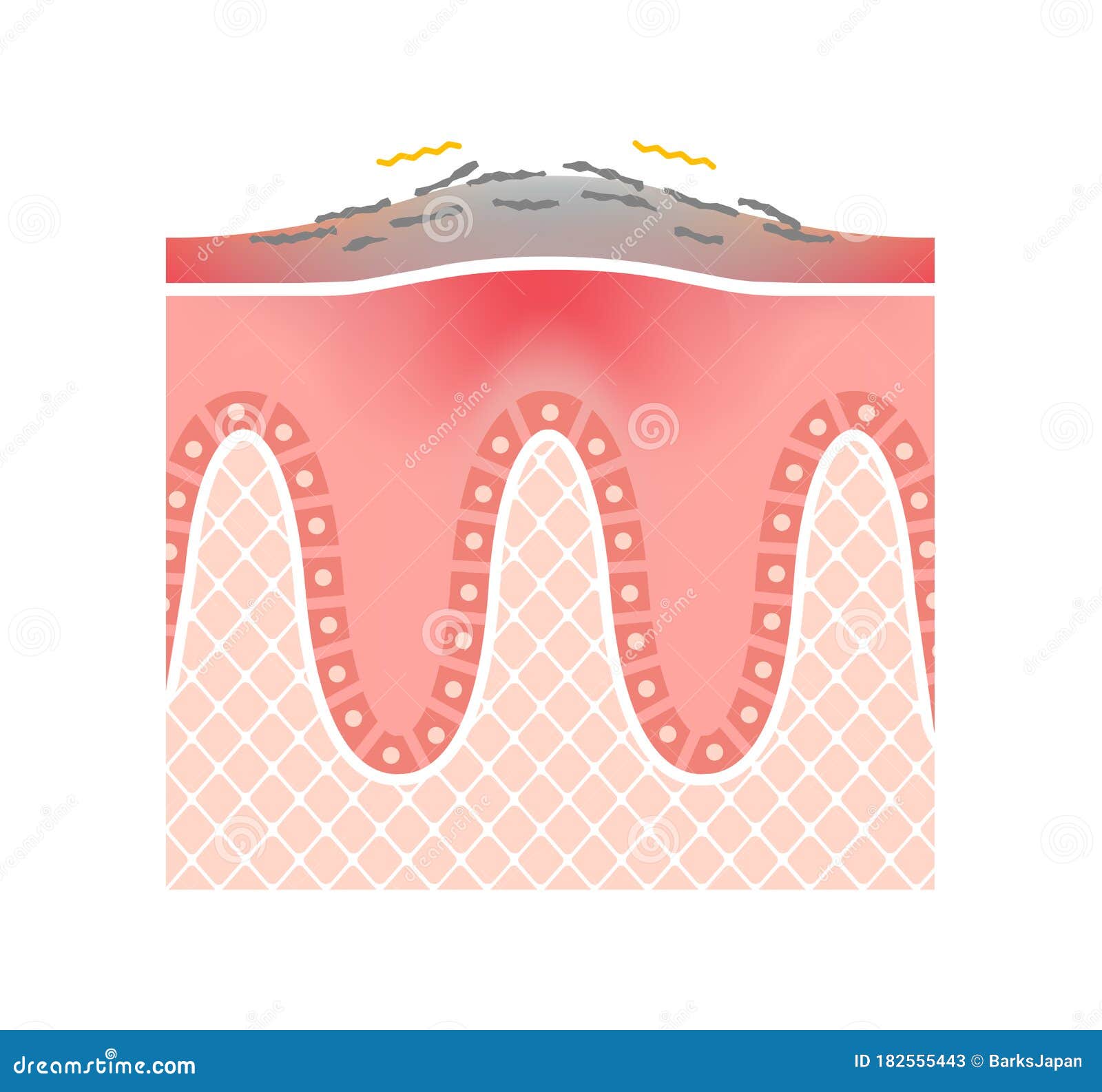 Cross Section of Psoriasis Skin / Flat Vector Illustration Stock Vector ...