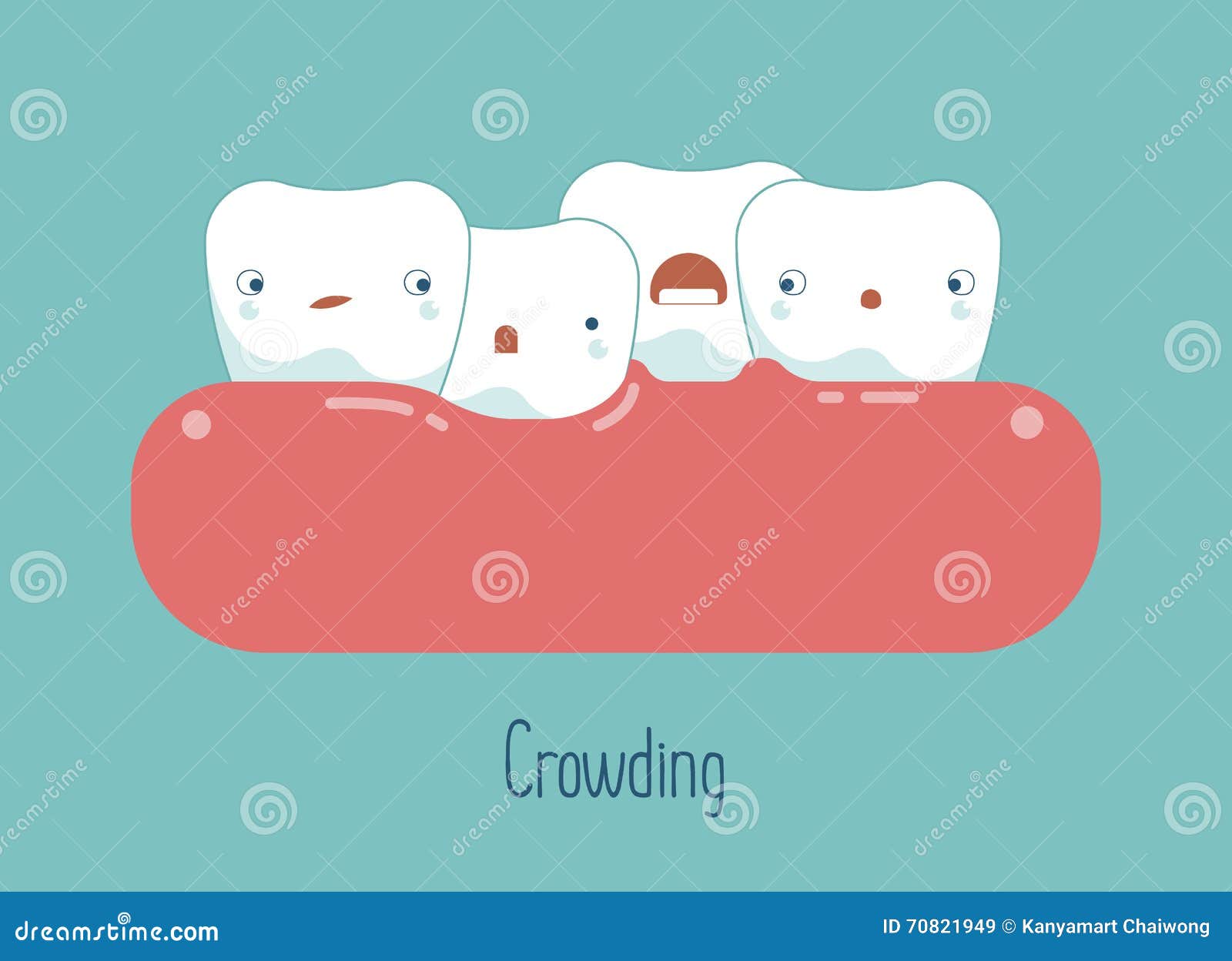 Row Of Teeth With Dental Implant - Teeth Prosthetics Scheme Vector ...