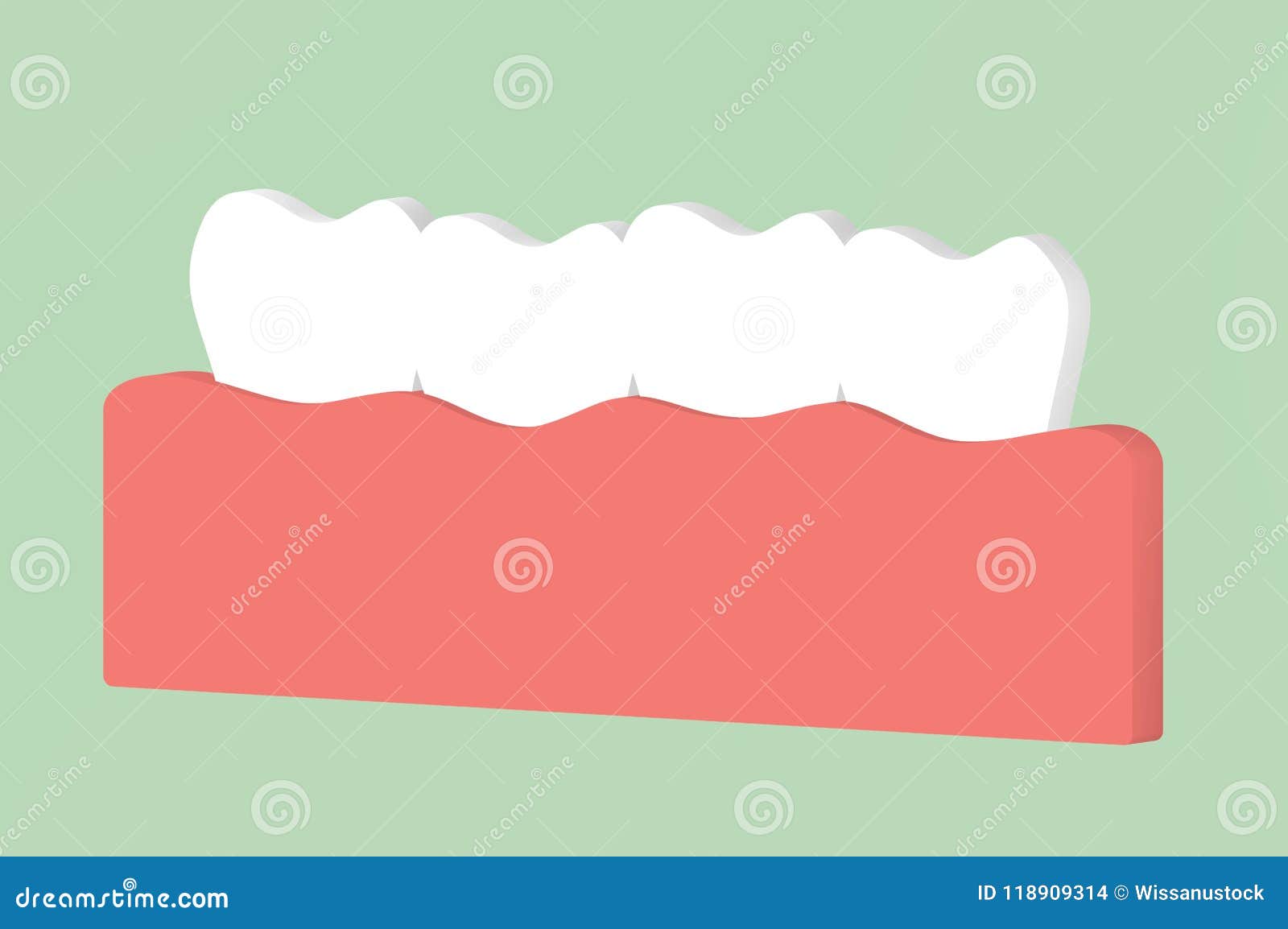 3d Render Of Jaw Malocclusion With Underbite Stock Image ...