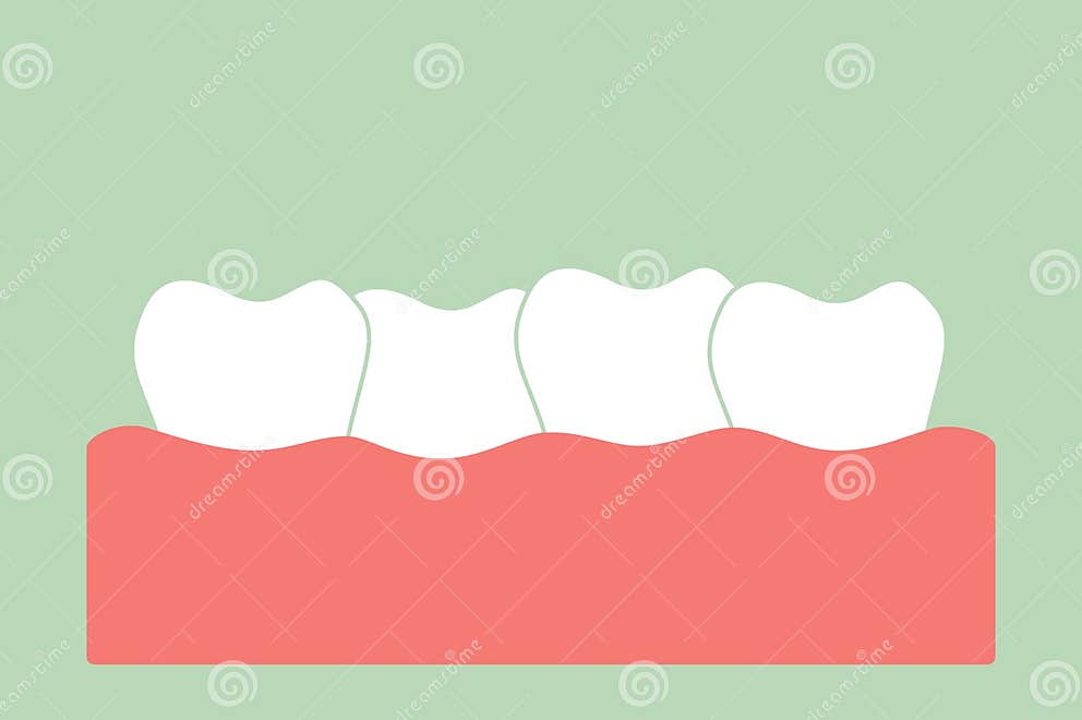 Crowding Teeth Malocclusion Stock Vector - Illustration of overcrowding ...