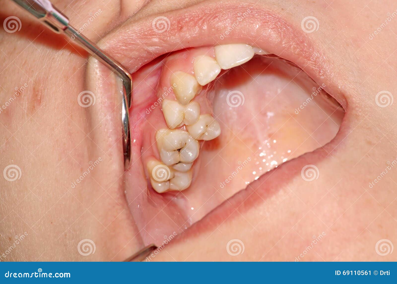 Malocclusion, Overcrowding Of Both Upper And Lower Teeth Stock Photo ...