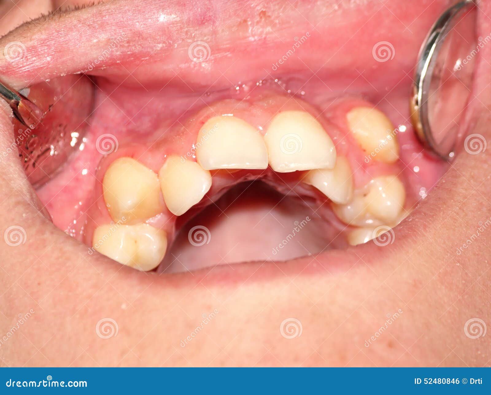 Malocclusion, Overcrowding Of Both Upper And Lower Teeth Stock Photo ...