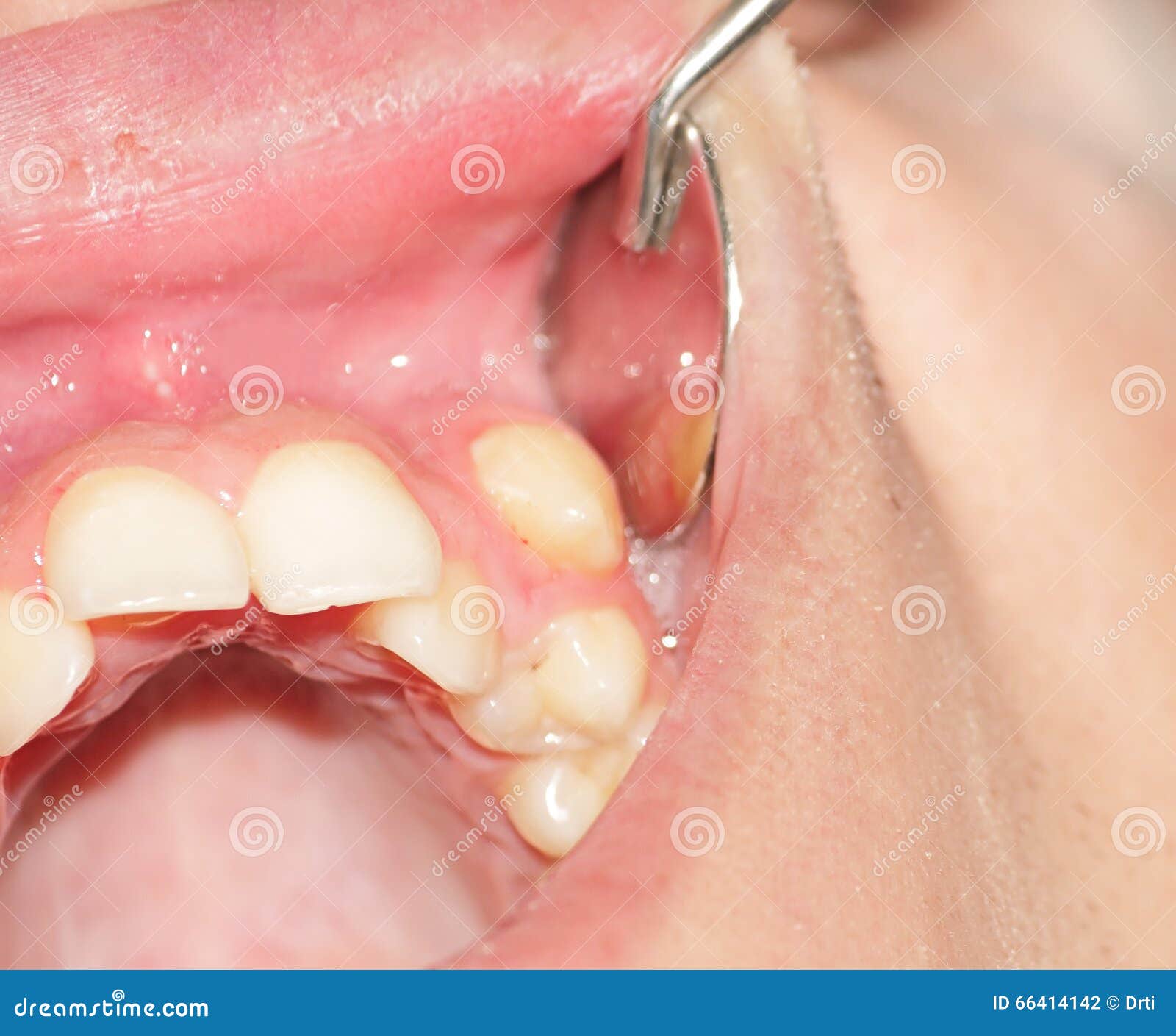 Crowding of the Teeth of the Upper Jaw Stock Photo - Image of caucasian ...