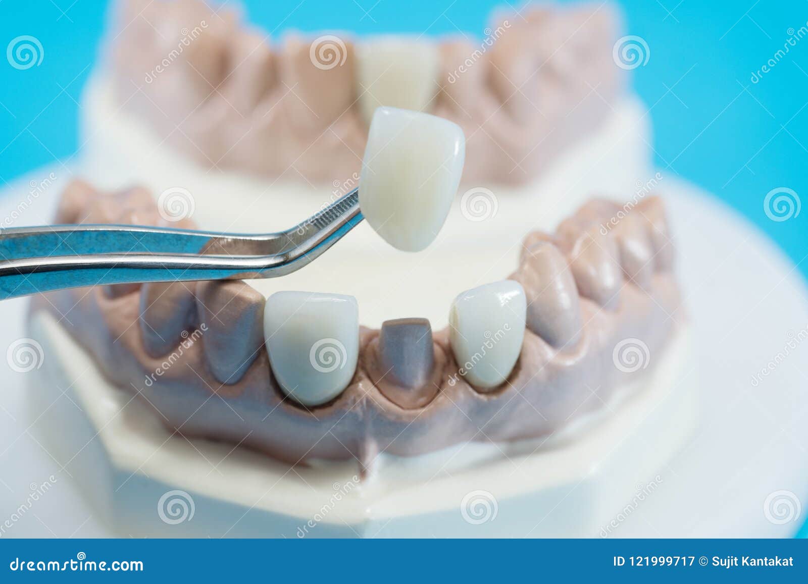 Dentist Tools and Prosthodontic Model. Stock Image - Image of bridge ...