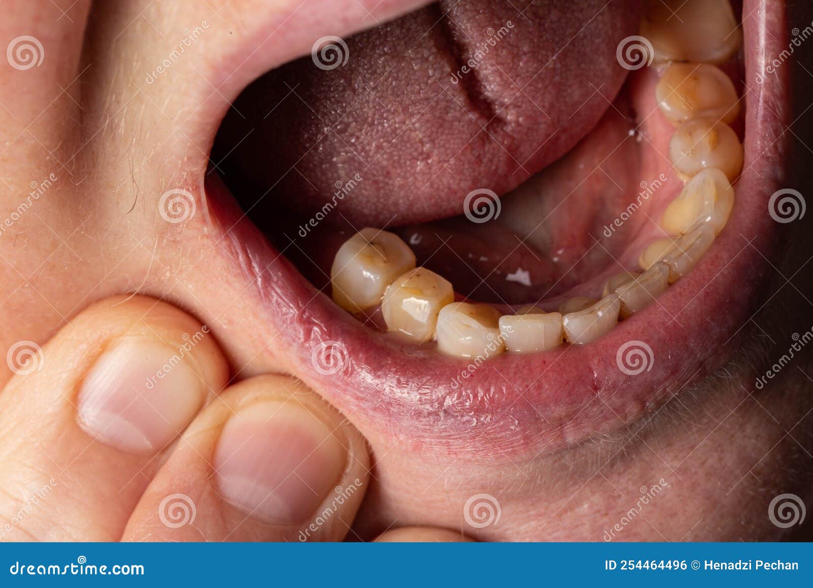 Crowned Teeth. Preparation of Teeth in Dentistry for the Installation ...