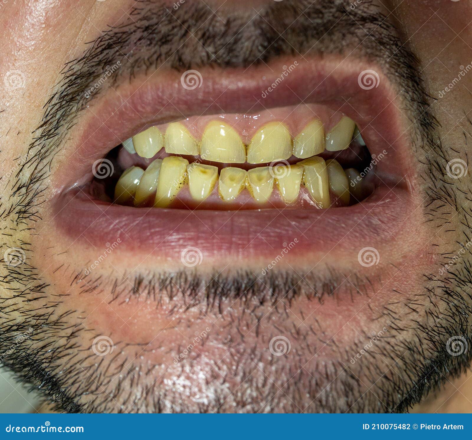 Crushed and Broken Teeth Due To Hard Bite and Constant Consumption of ...
