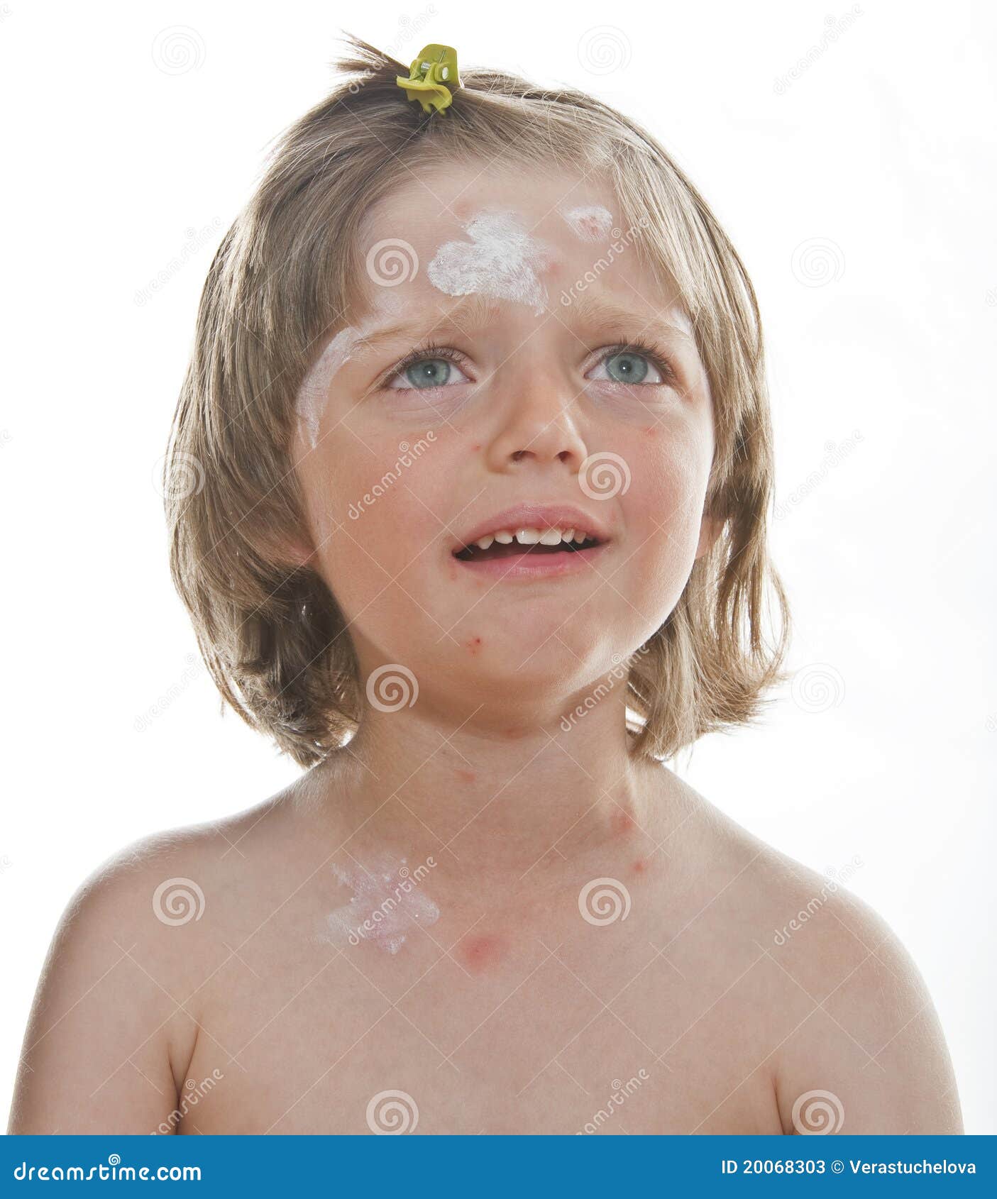 Crying Little Girl with Smallpox Stock Image - Image of condition ...