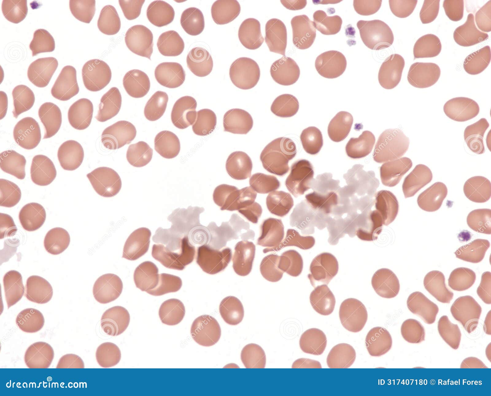Cryoglobulinemia. Peripheral Blood Smear. Stock Photo - Image of ...