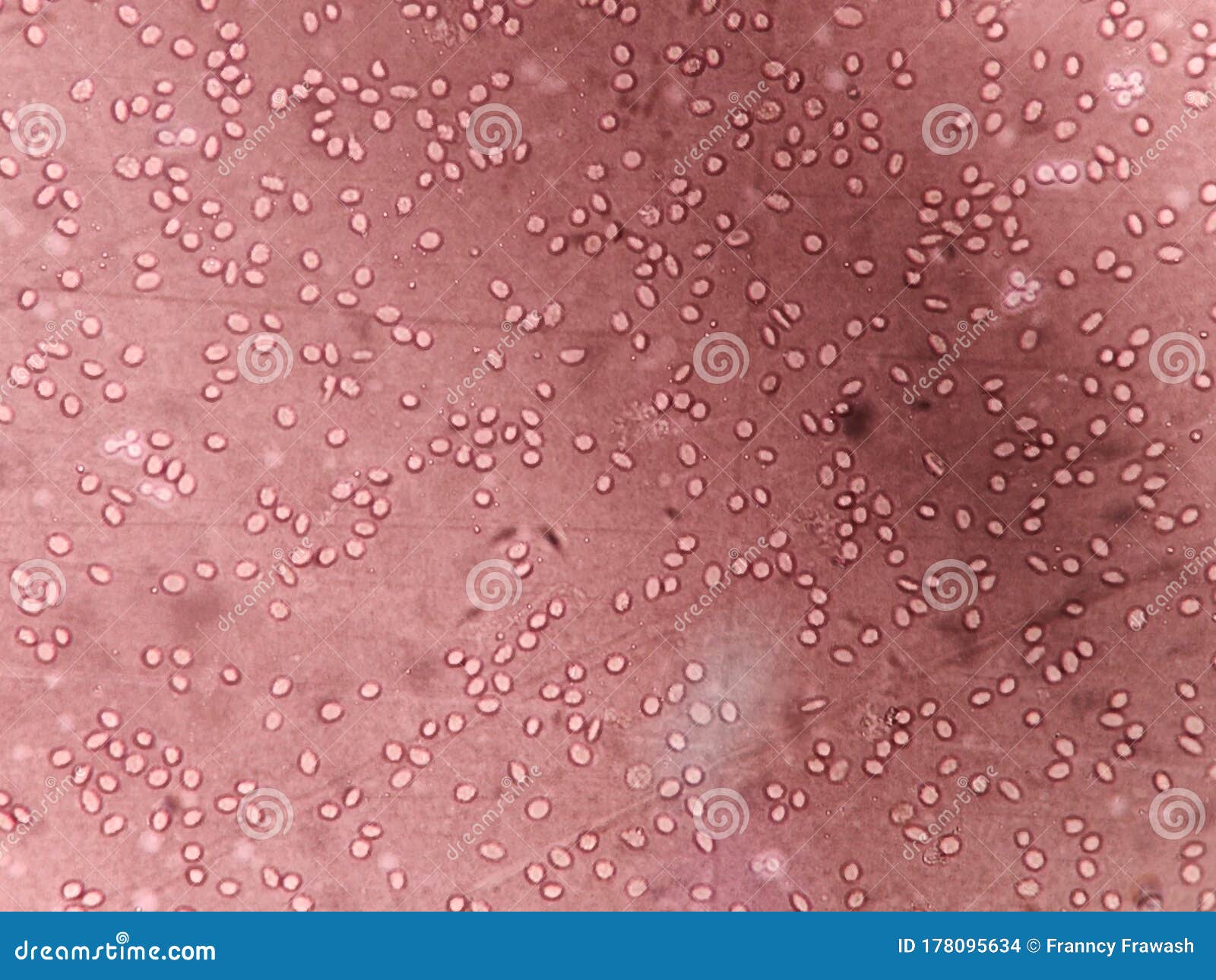 Cryptococcus Neoformans - Cerebrospinal Fluid Stock Photo - Image of ...