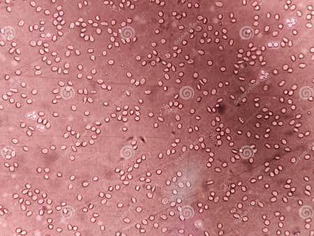 Cryptococcus Neoformans - Cerebrospinal Fluid Stock Photo - Image of ...