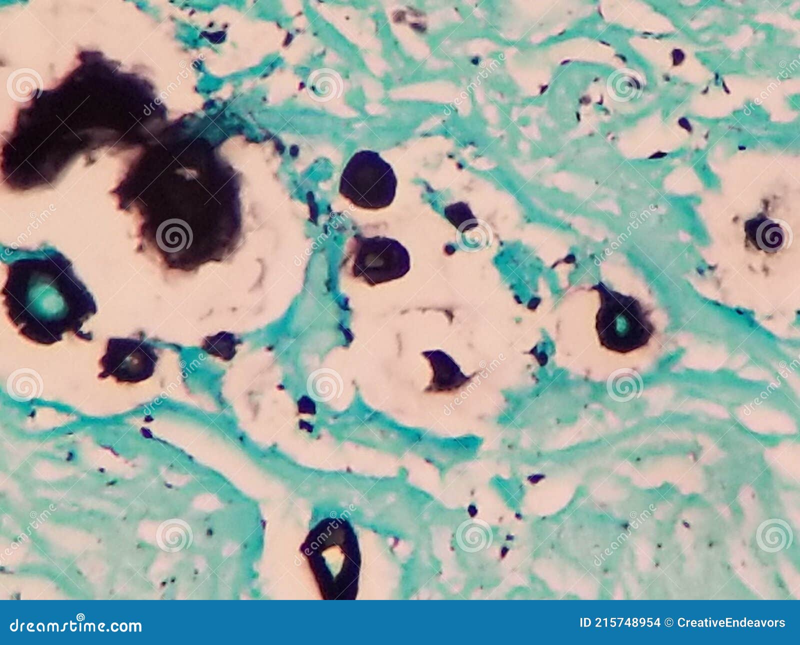 Cryptococcus Neoformans in Lung Tissue - Warthin Starry Silver Stain ...