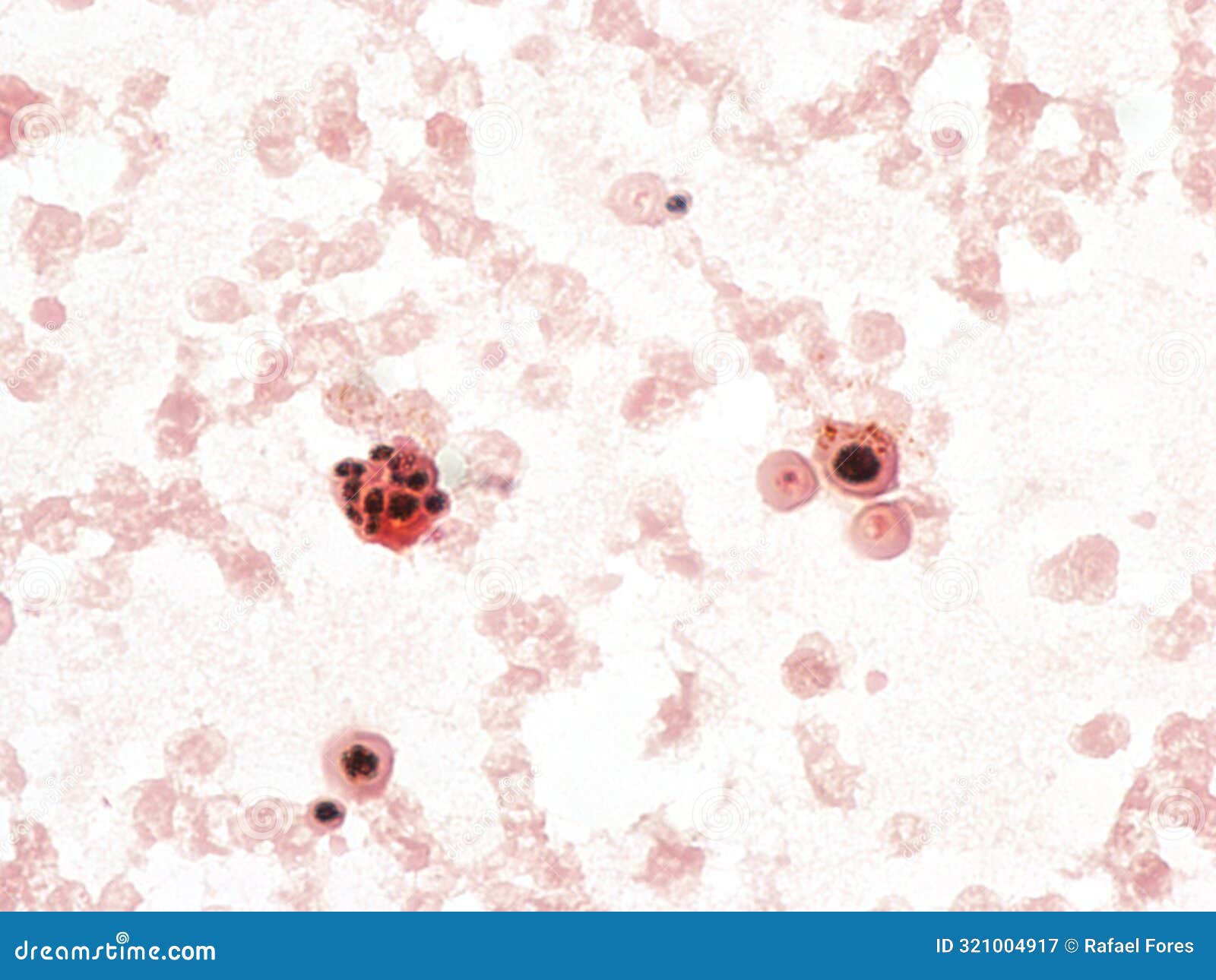 Cryptococcus in Peripheral Blood Smear. Gram Stain. Stock Image - Image ...