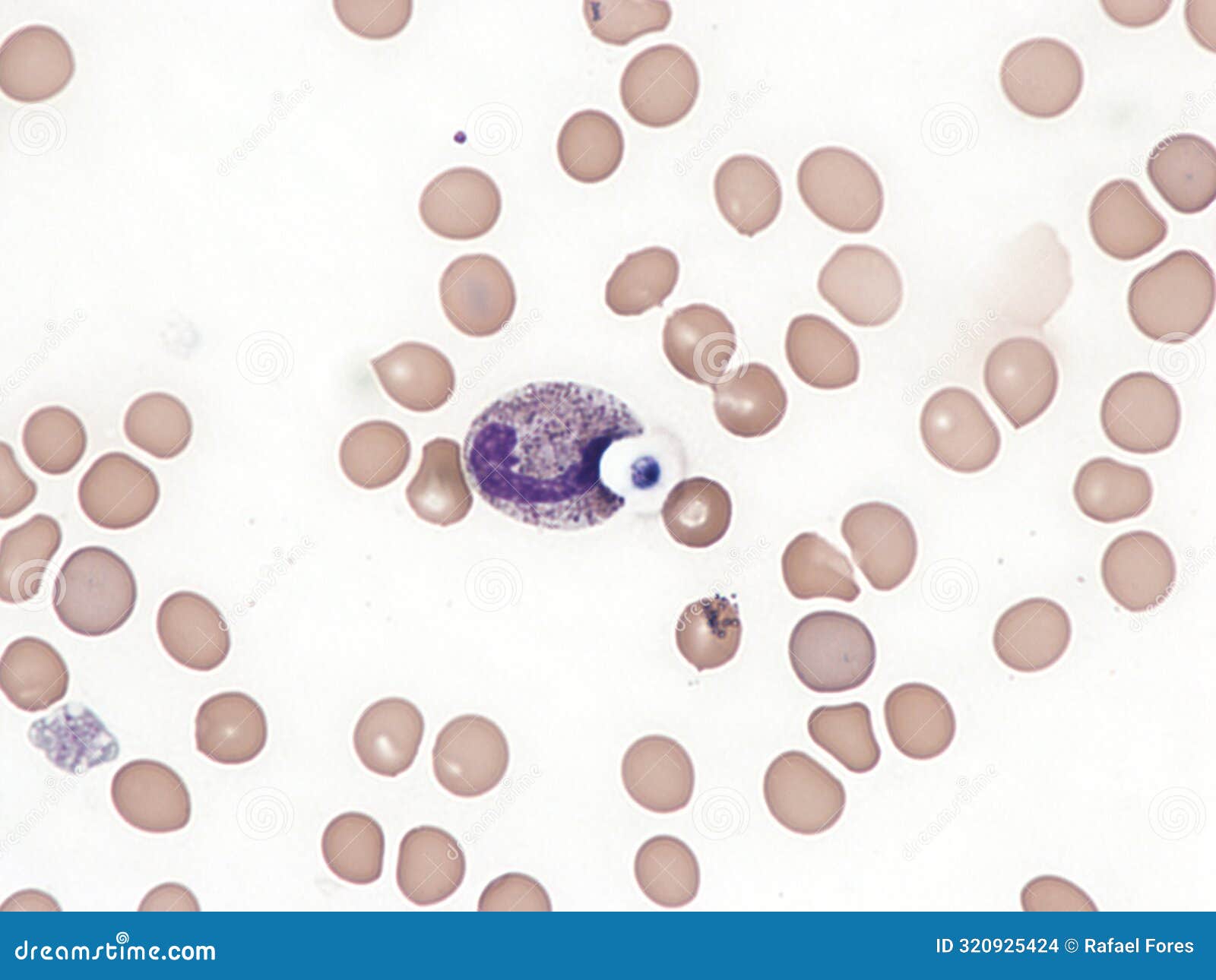 Cryptococcus in Peripheral Blood Smear. Stock Photo - Image of ...