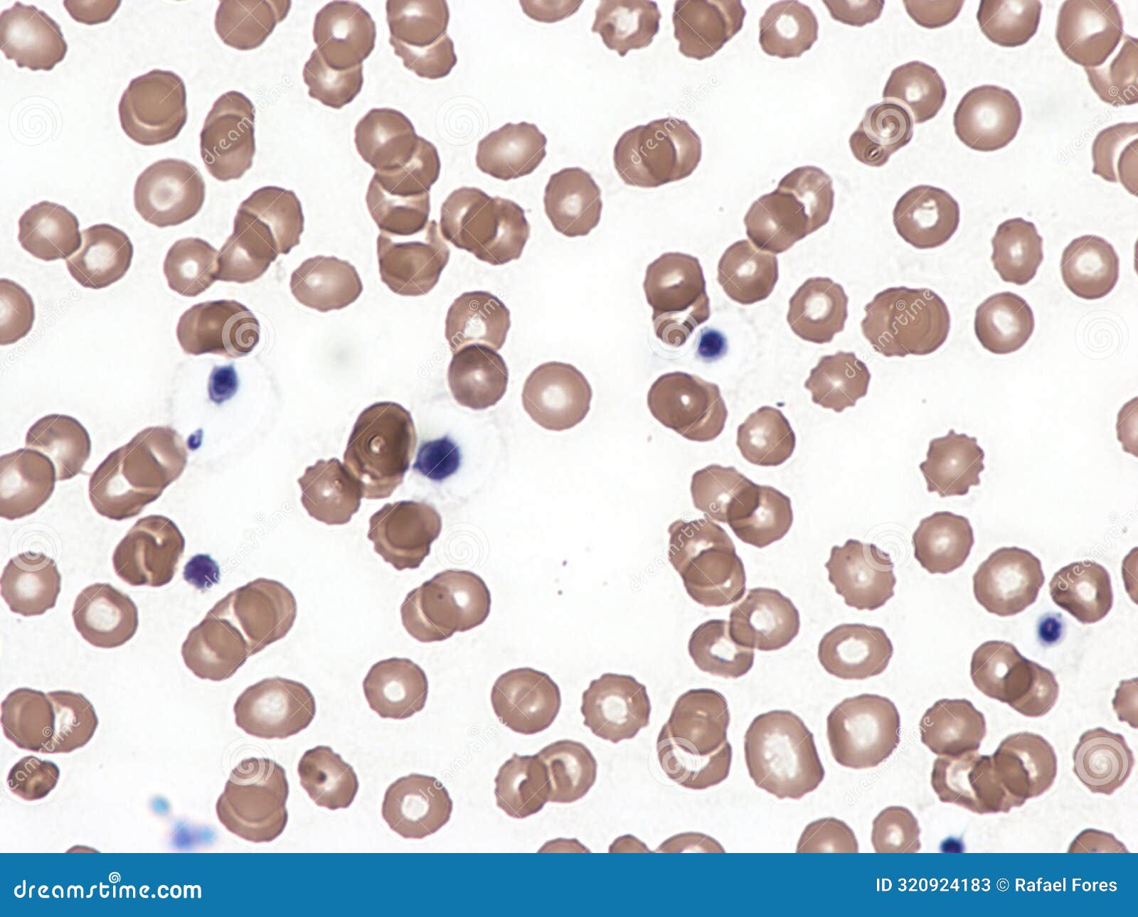 Cryptococcus in Peripheral Blood Smear. Stock Image - Image of wright ...