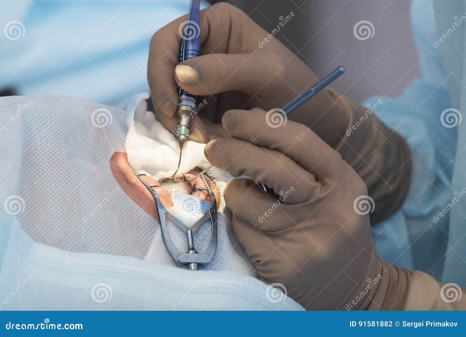 Crystalline Lens Replaceable Surgical Method Stock Photo - Image of ...