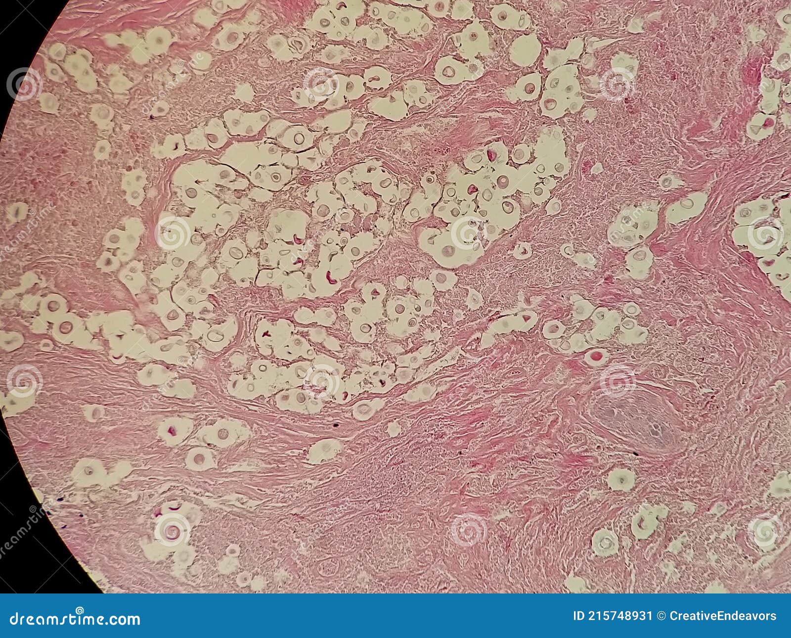Cryptococcus Neoformans In Lung Tissue - Warthin Starry Silver Stain ...