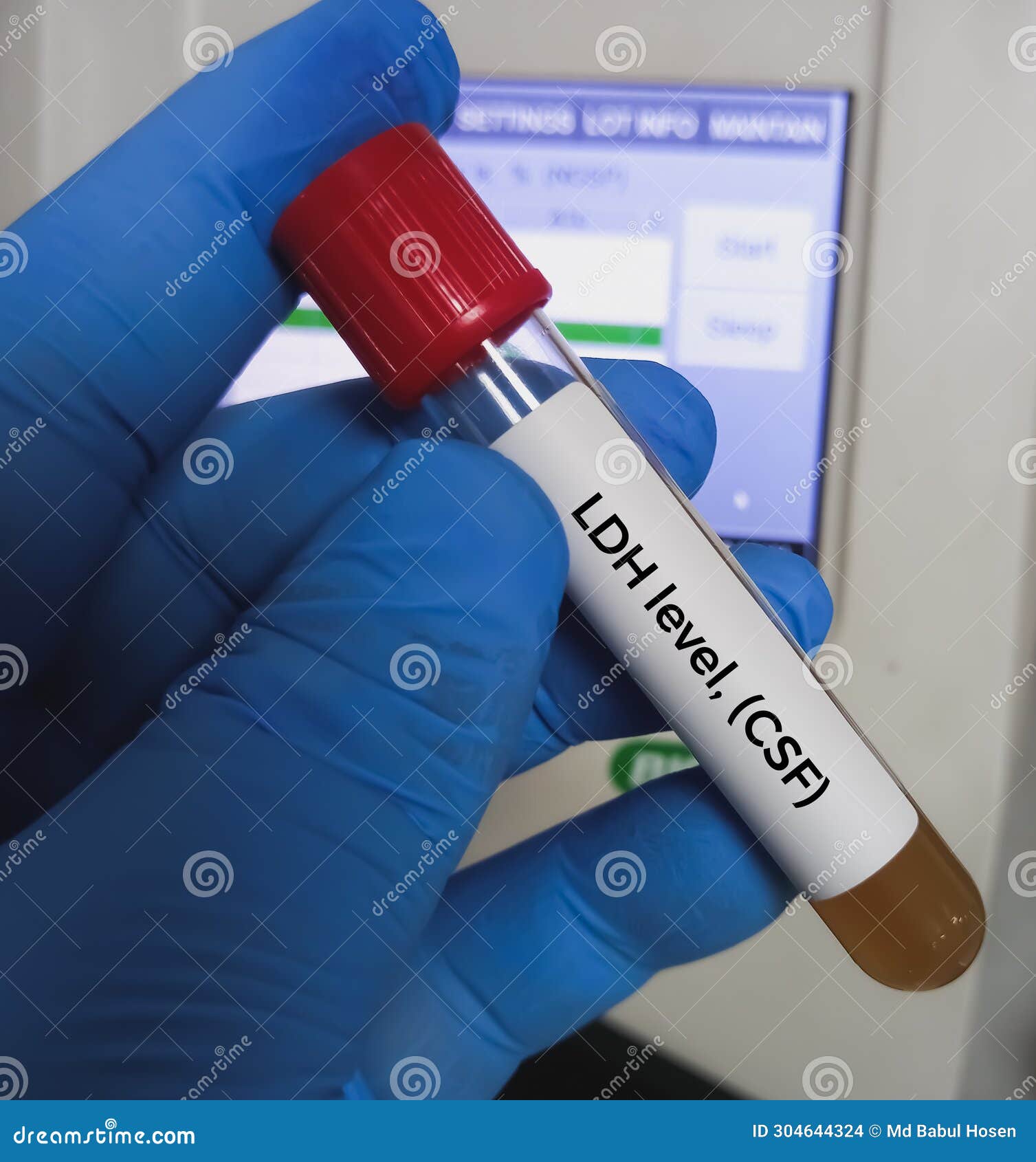 CSF Sample for LDH (lactate Dehydrogenase) Test Stock Photo - Image of ...