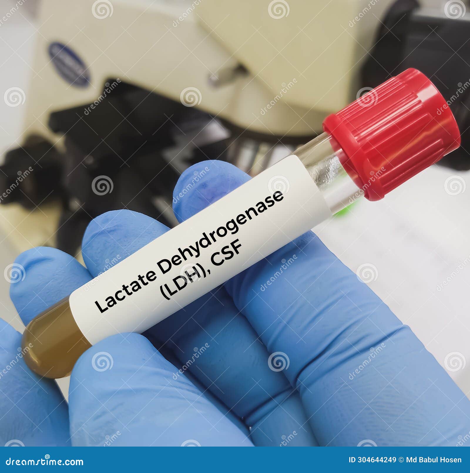 CSF Sample for LDH (lactate Dehydrogenase) Test Stock Image - Image of ...
