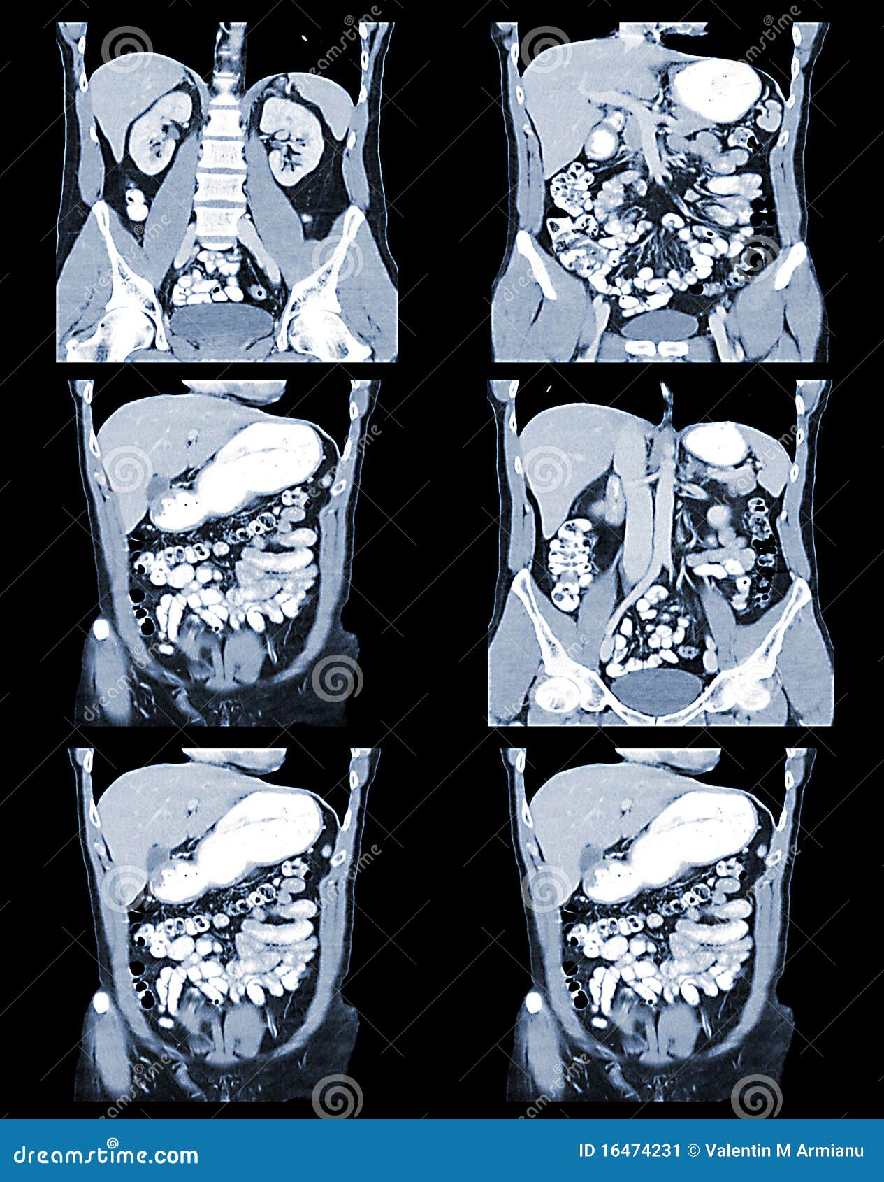 CT Abdomen stock image. Image of human, design, health - 16474231