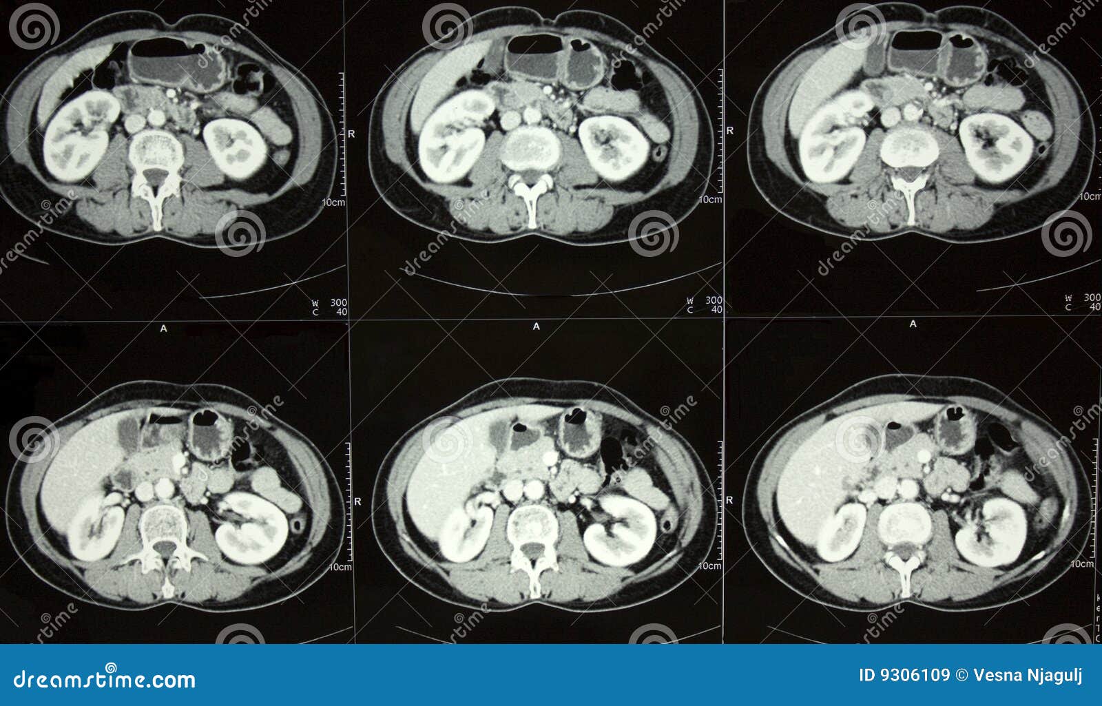 CT of Abdomen, Liver, Spleen, Kidneys Stock Image - Image of computed ...