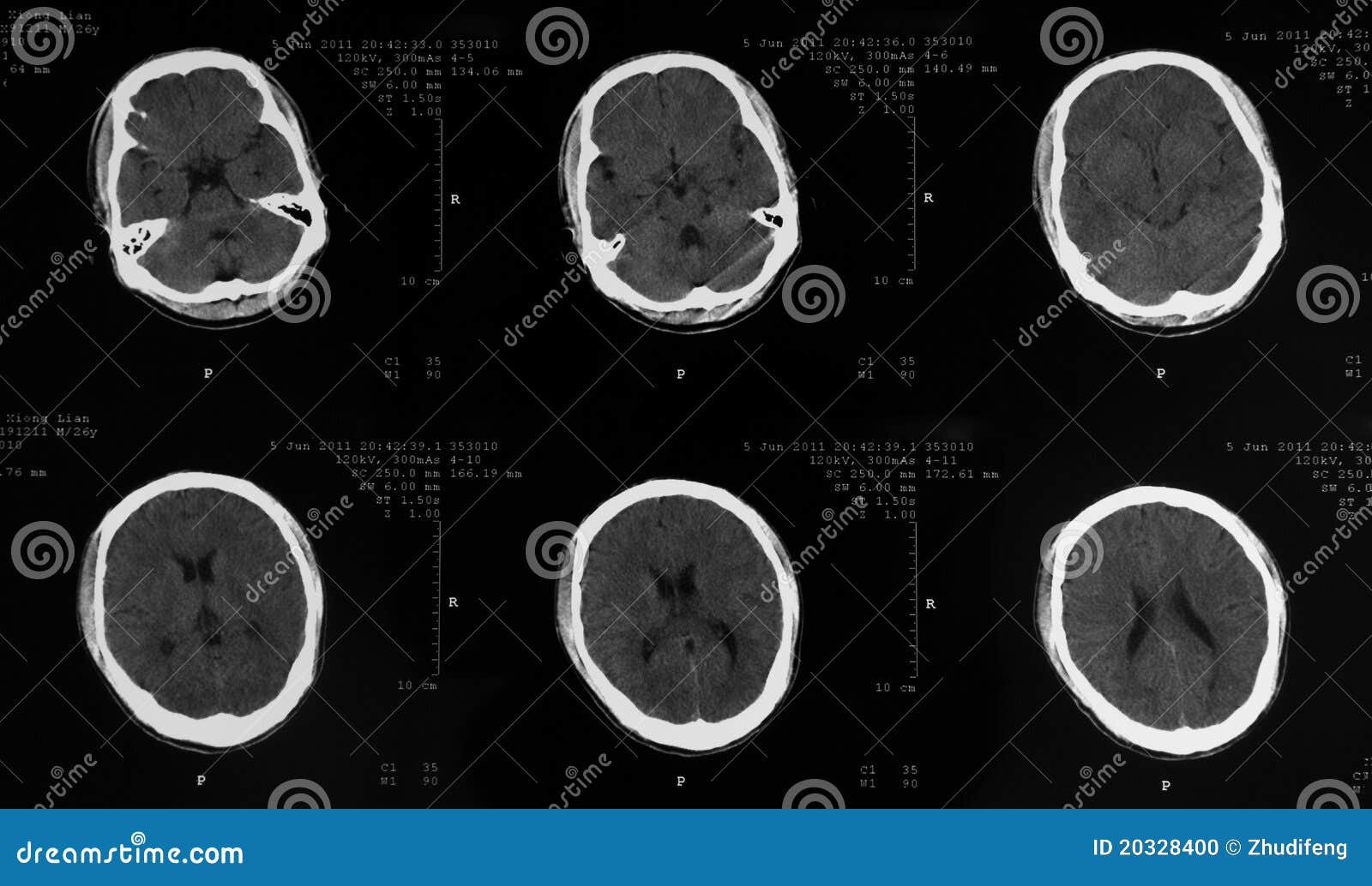 CT of brain stock photo. Image of radiation, laboratory - 20328400