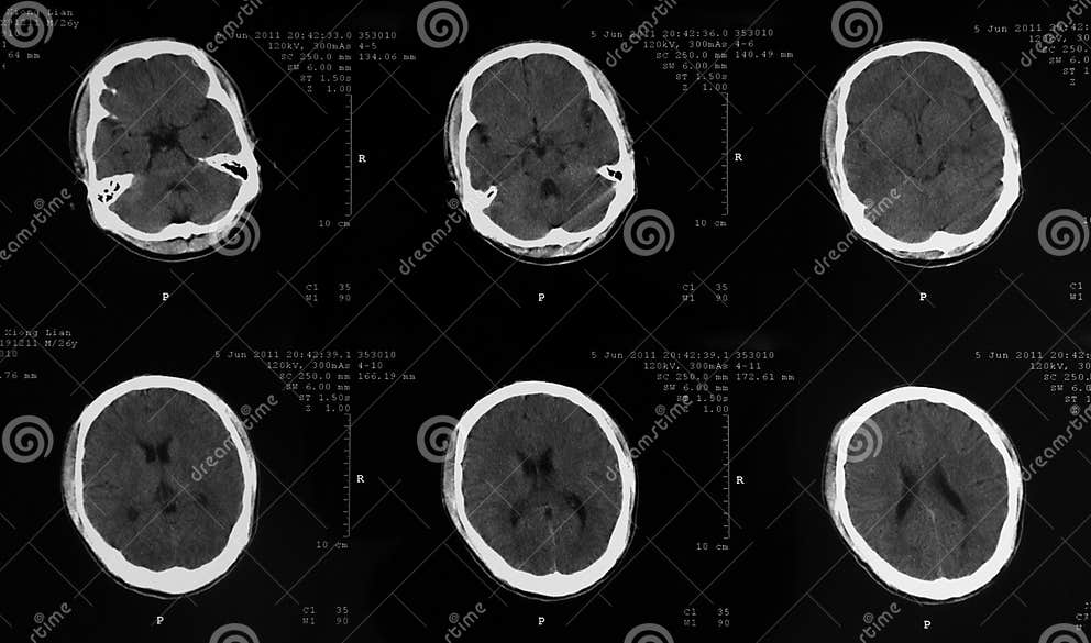 CT of brain stock photo. Image of radiation, laboratory - 20328400