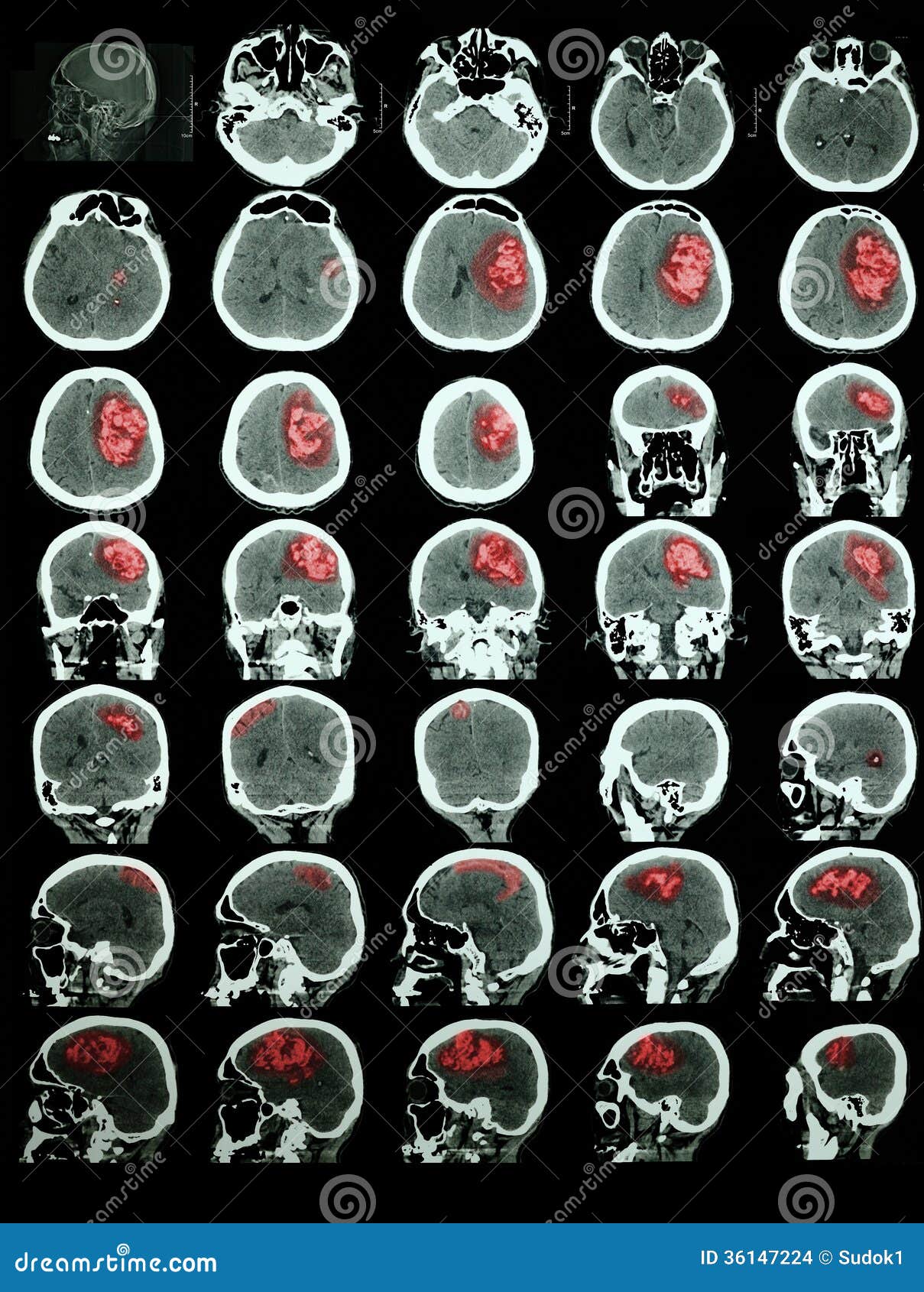 Hemorrhagic Stroke And Ischemic Stroke . CT Scan Of Brain ...