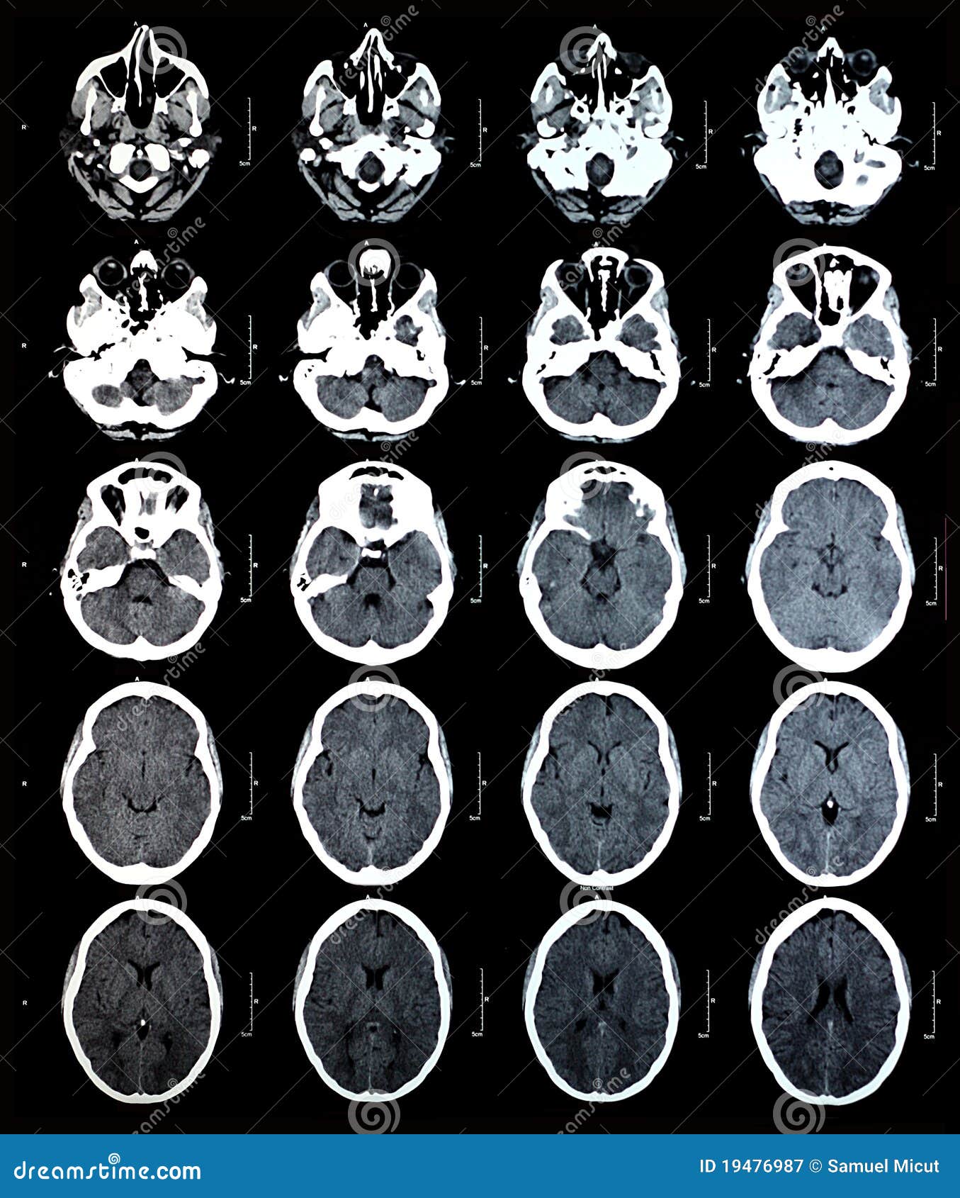 CT brain images stock image. Image of head, hospital - 19476987