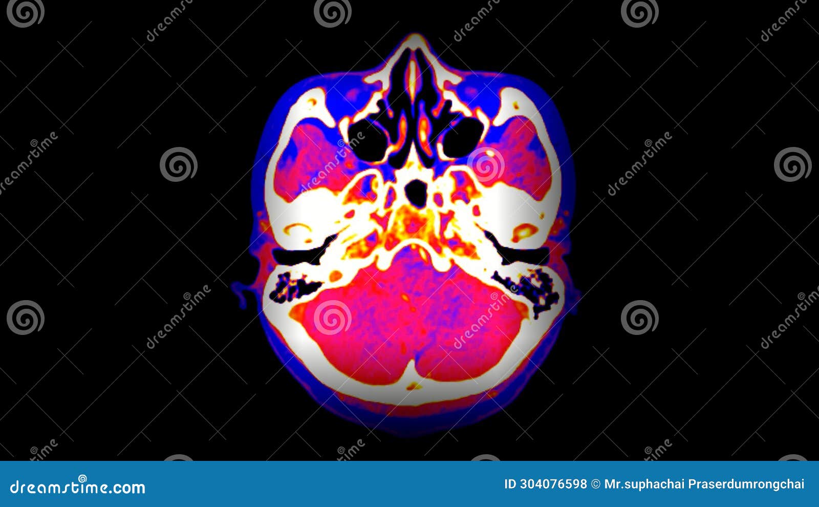 CT Brain Perfusion or CT Scan Image of the Brain Axial View Stock Photo ...
