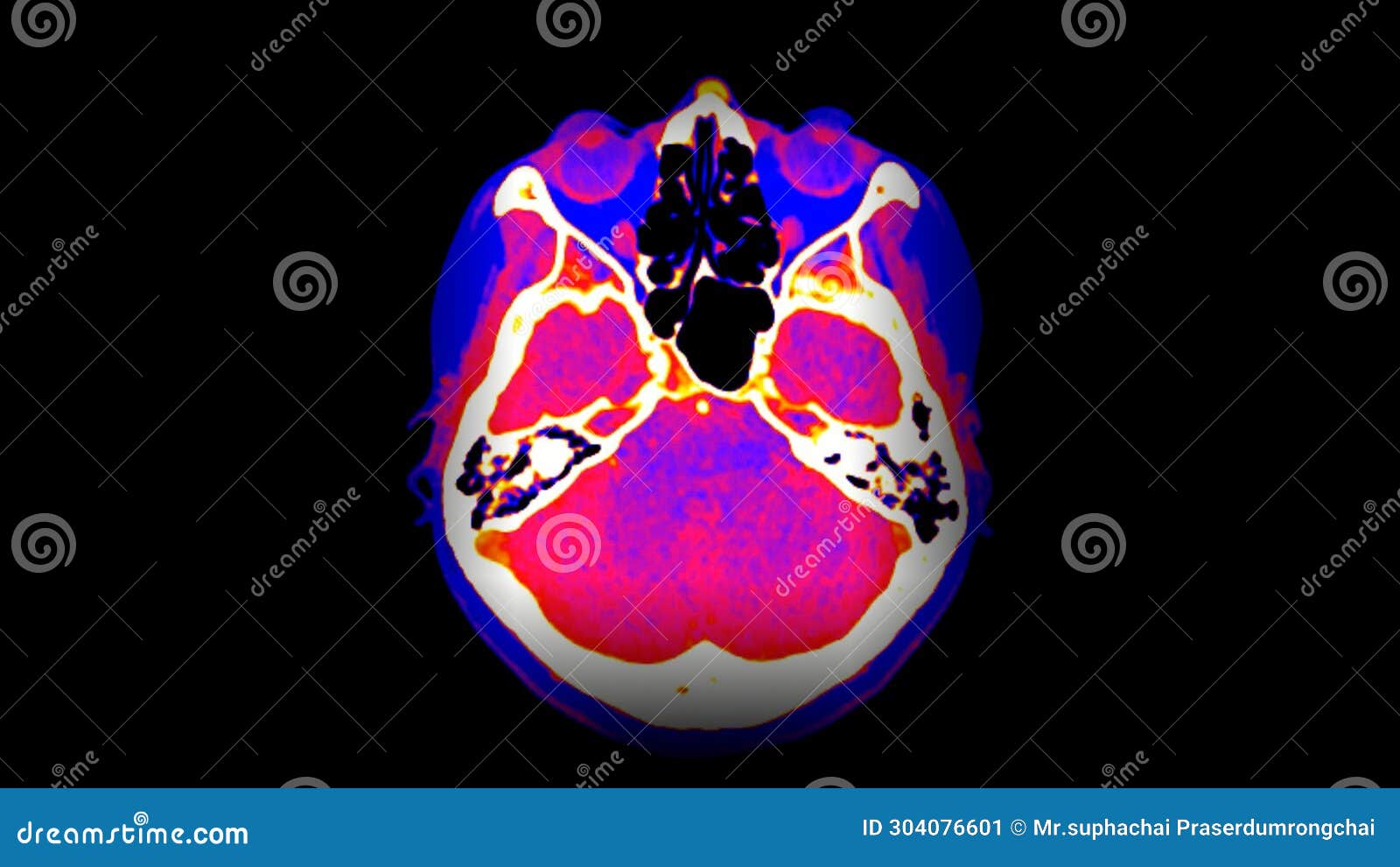 CT Brain Perfusion or CT Scan Image of the Brain Axial View Stock Image ...