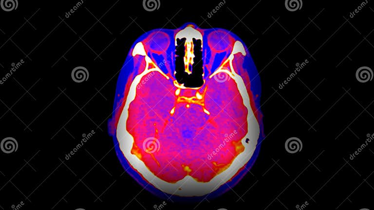 CT Brain Perfusion or CT Scan Image of the Brain Axial View Stock Image ...