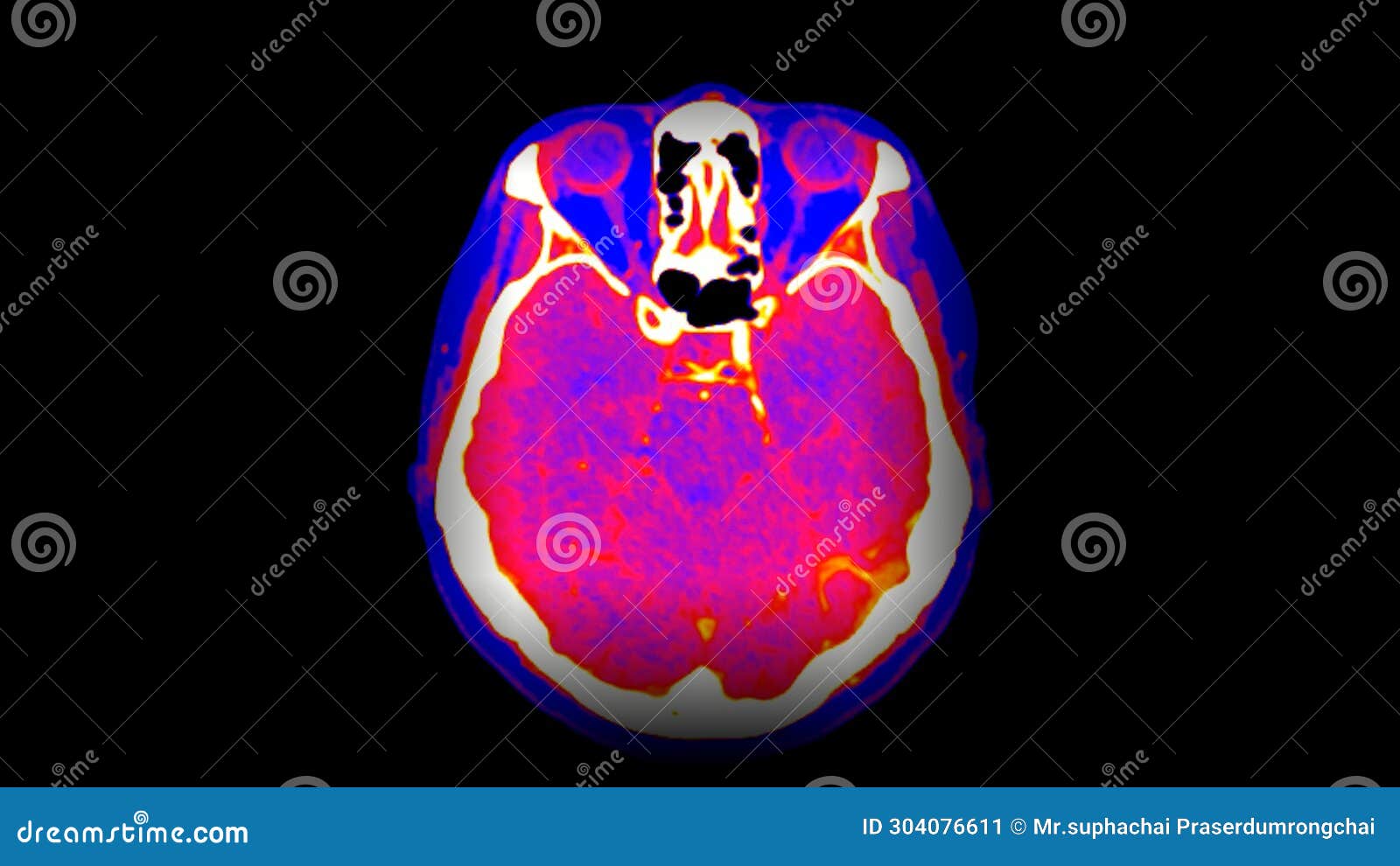 CT Brain Perfusion or CT Scan Image of the Brain Axial View Stock Image ...