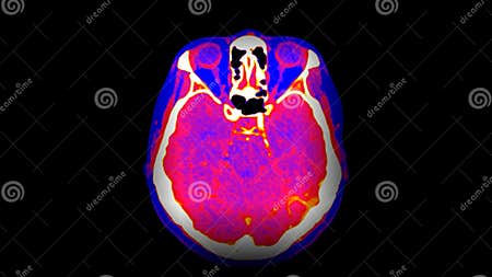 CT Brain Perfusion or CT Scan Image of the Brain Axial View Stock Image ...