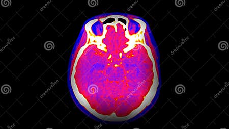 CT Brain Perfusion or CT Scan Image of the Brain Axial View Stock Photo ...