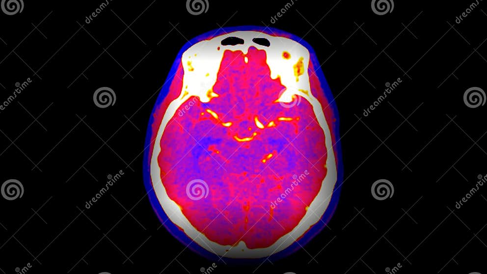 CT Brain Perfusion or CT Scan Image of the Brain Axial View Stock Photo ...
