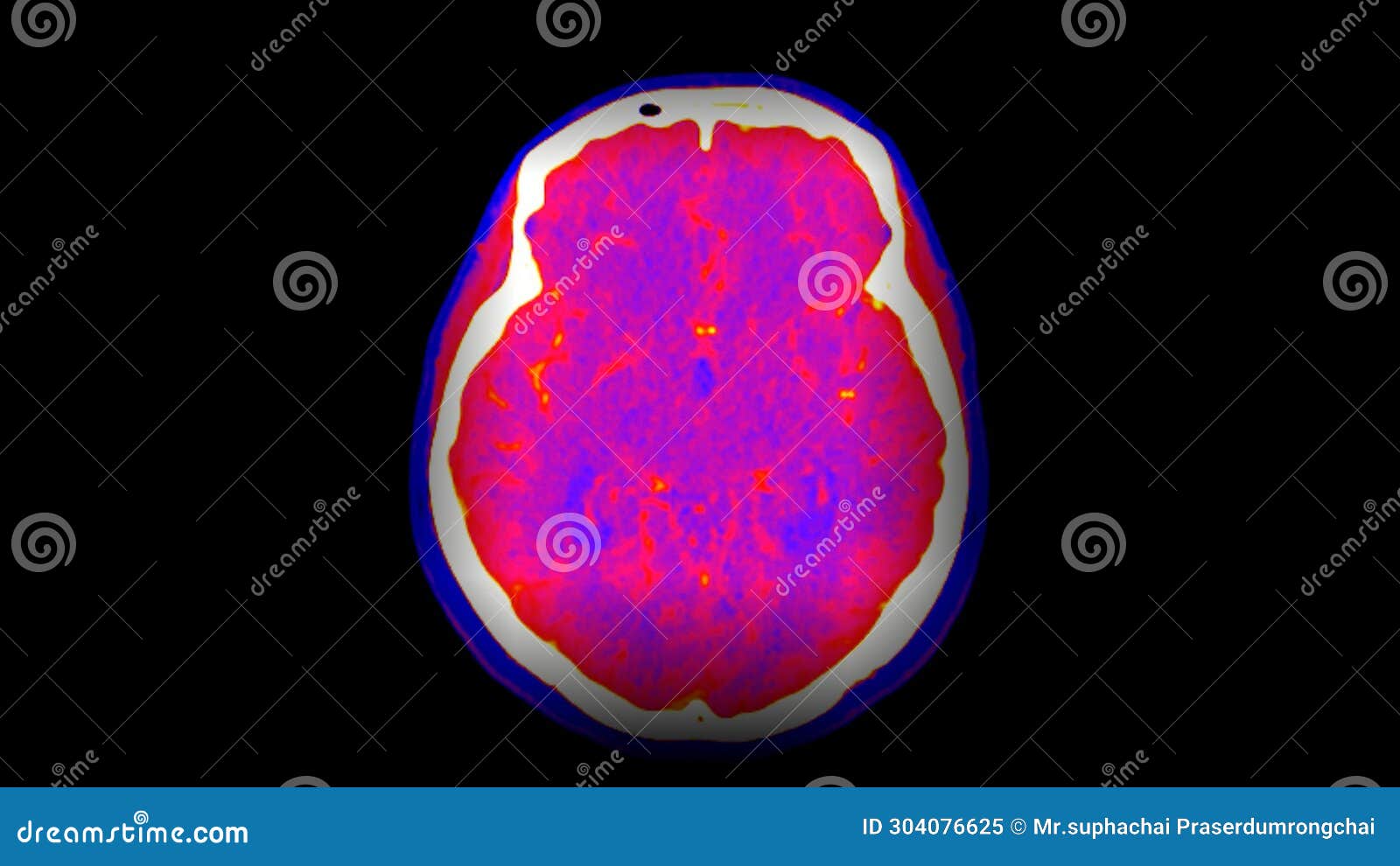CT Brain Perfusion or CT Scan Image of the Brain Axial View Stock Image ...